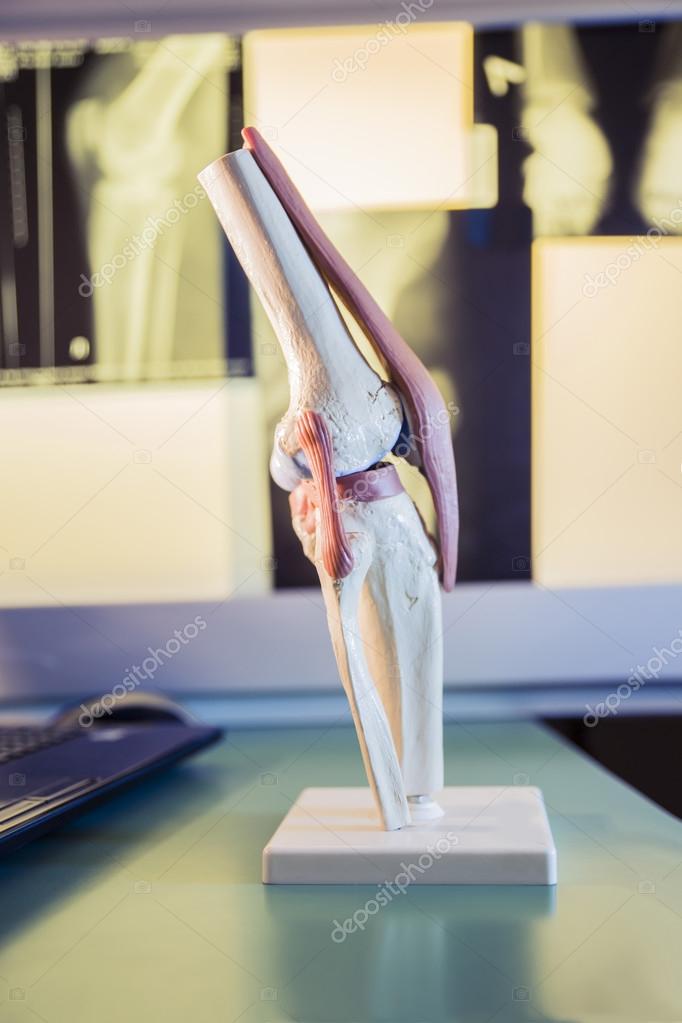 Closeup scale model the layout of the artificial knee joint in x-ray ...