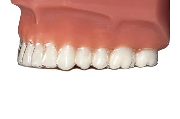 Invisible orthodontic removable aligners for treatments bruxism — Stock ...
