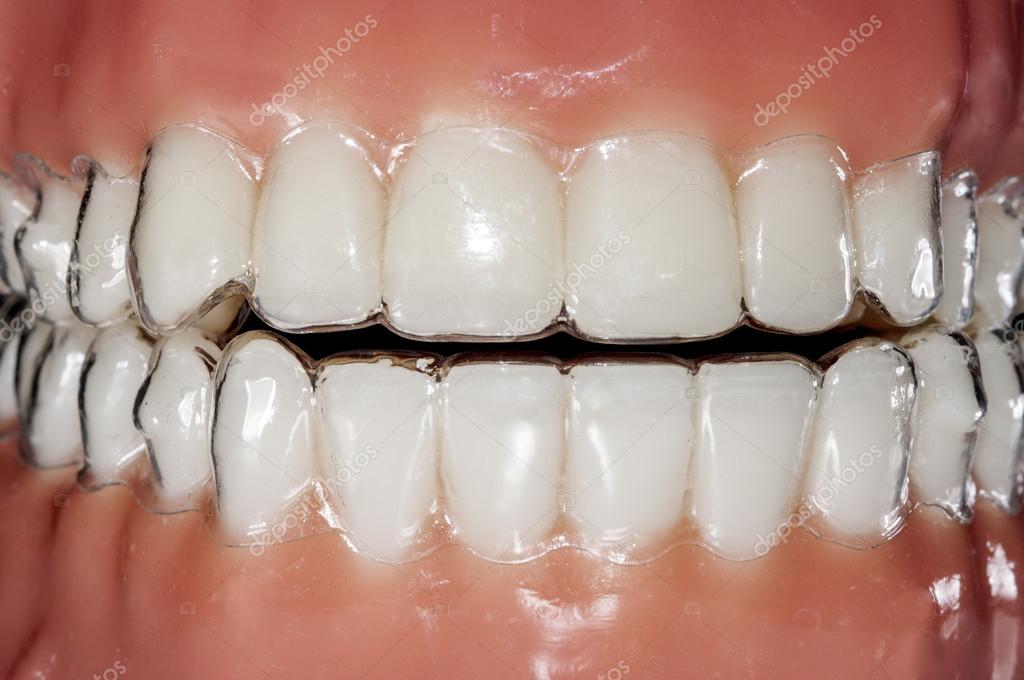 Invisible and removable aligners for teeth treatment Stock Photo by ...