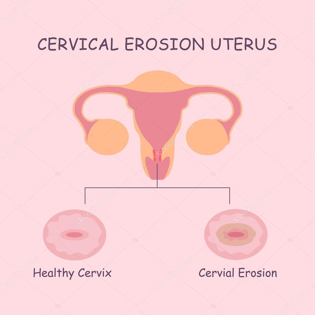 Uterus and cervial erosion Stock Vector Image by ©etoileark #99877460