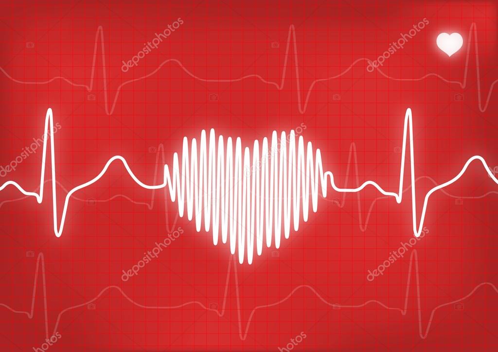 Epsilon Wave Ekg Monitor