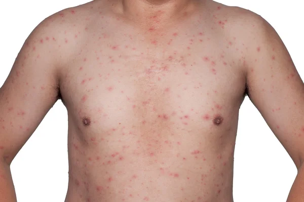Chickenpox back view. — Stock Photo © nhumnoi #104976016