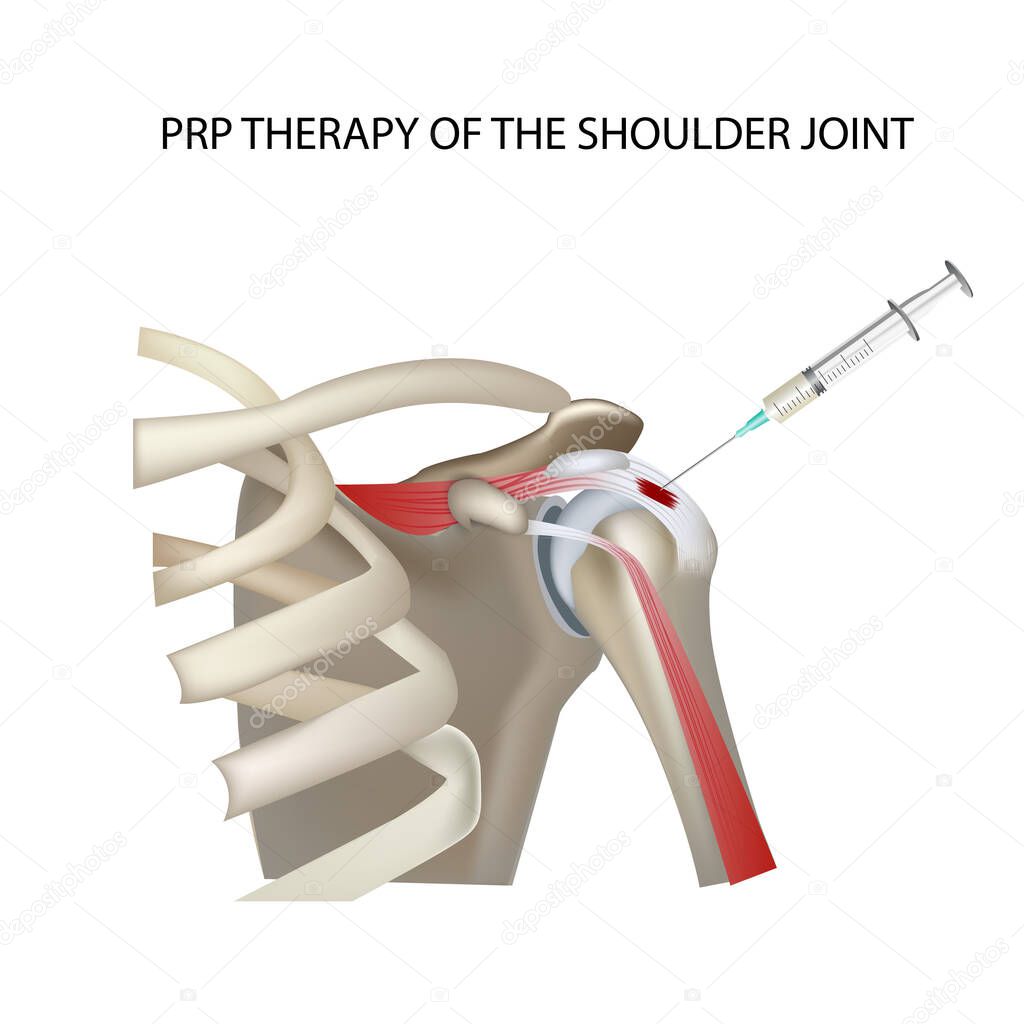 PRP therapy of the shoulder joint, vector medical illustration vector ...