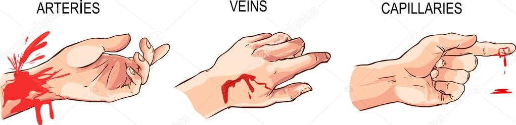 Arterial and venous bleeding — Stock Vector © corbacserdar.gmail.com ...