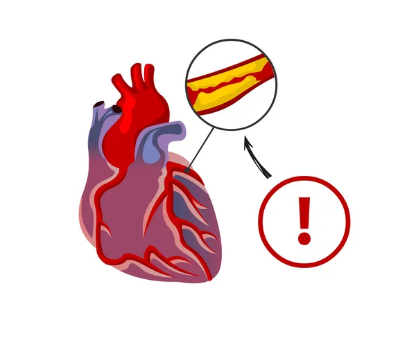 Infarto al miocardio imágenes de stock de arte vectorial | Depositphotos