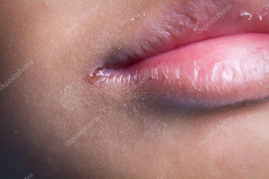 Angular Cheilitis Vs Cold Sore Ph