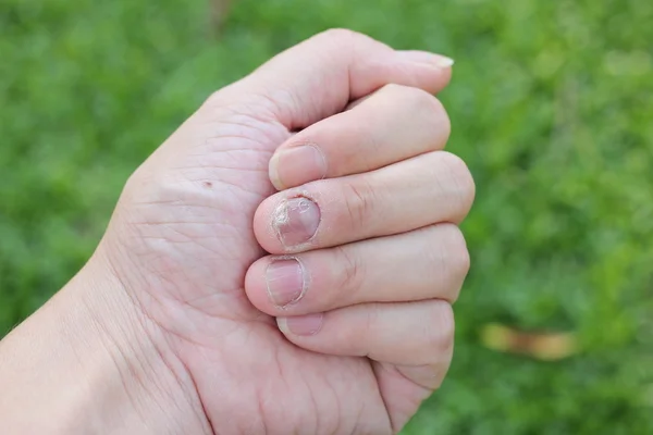 Fungus Infection Nails Hand Finger Onychomycosis Fungal Infection Nails ...