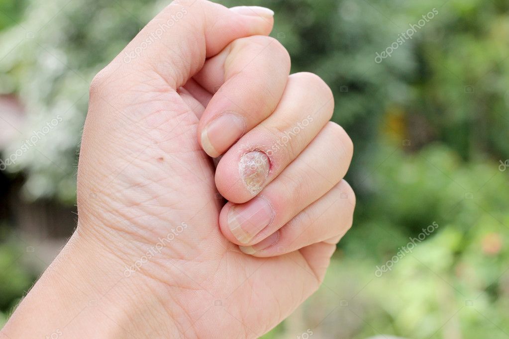 Infección por hongos en las uñas Mano, Dedo con onicomicosis, Un hongo ...