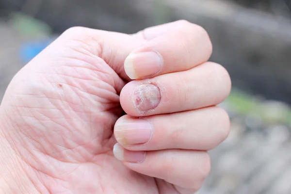 Fungus Infection on Nails Hand, Finger with onychomycosis, Fungal ...