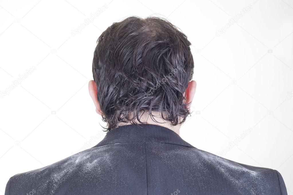 Man with dandruff on his shoulders. Stock Photo by ©Luisecheverriurrea ...