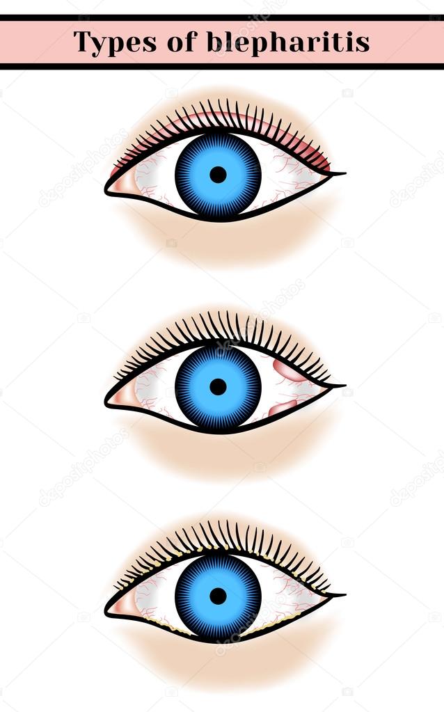 Blefaritis. Ojos purulentos, inflamatorios enfermedad . Vector de stock ...