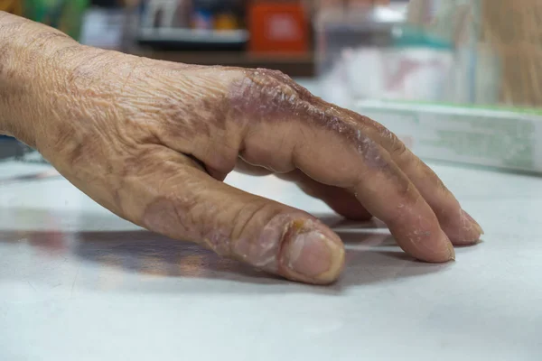 3rd Degree Burn Hand