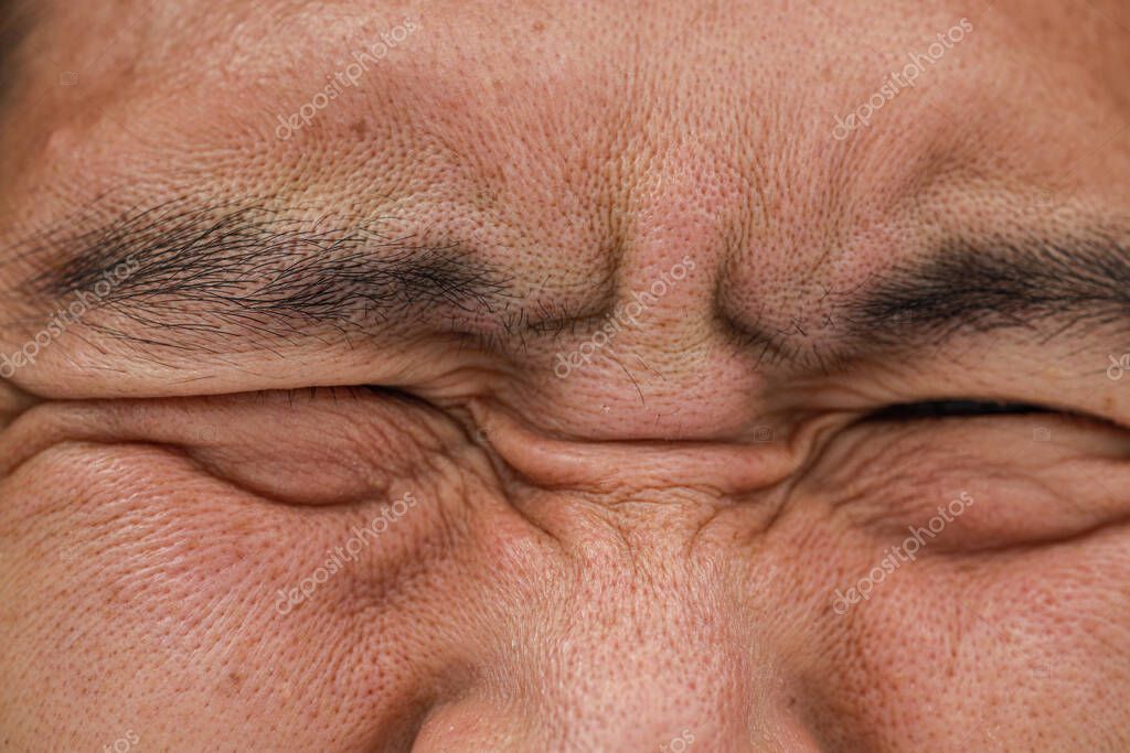 primer plano feo mala cara masculina aceitosa con grandes poros de la ...