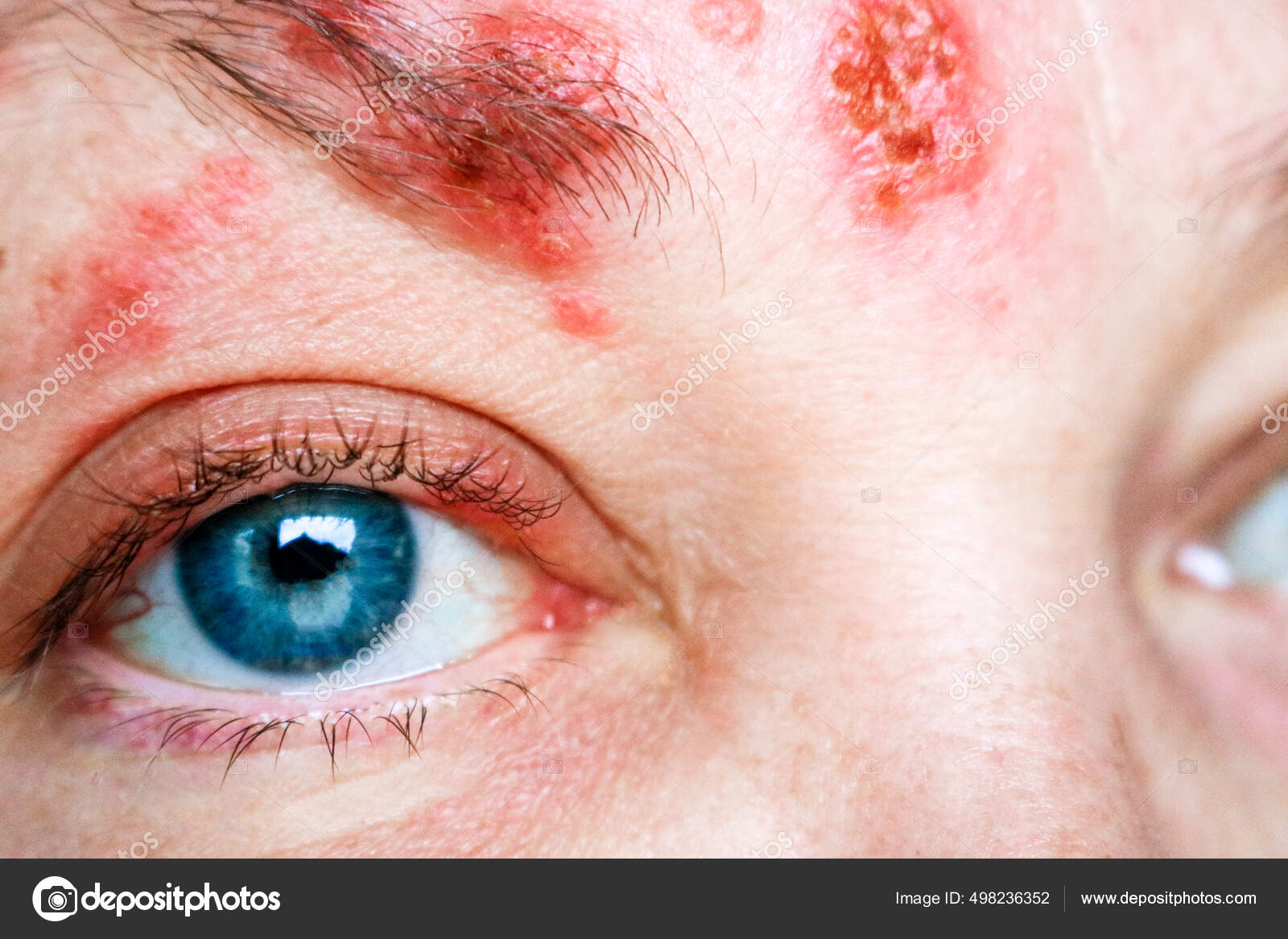 Culebrilla Cara Alrededor Del Ojo Llamado Herpes Oftálmico Zoster ...