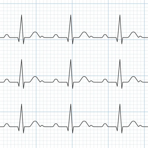 Heart Cardiogram Vector Charts Set Healthy Heart Rhythm Ischemia