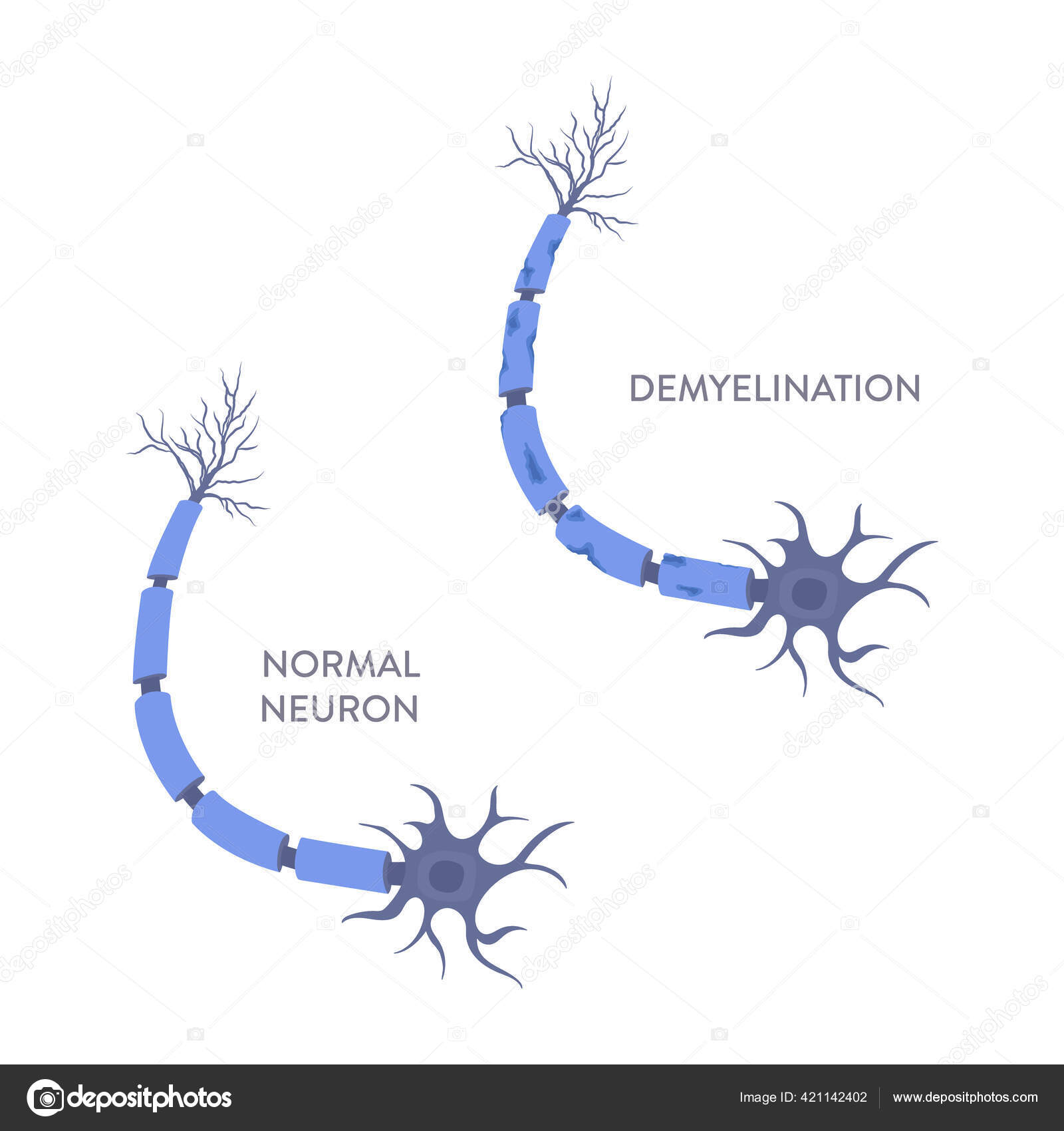Healthy Damaged Neuron Diagram Demyelination Neuron Shealth Microscope ...