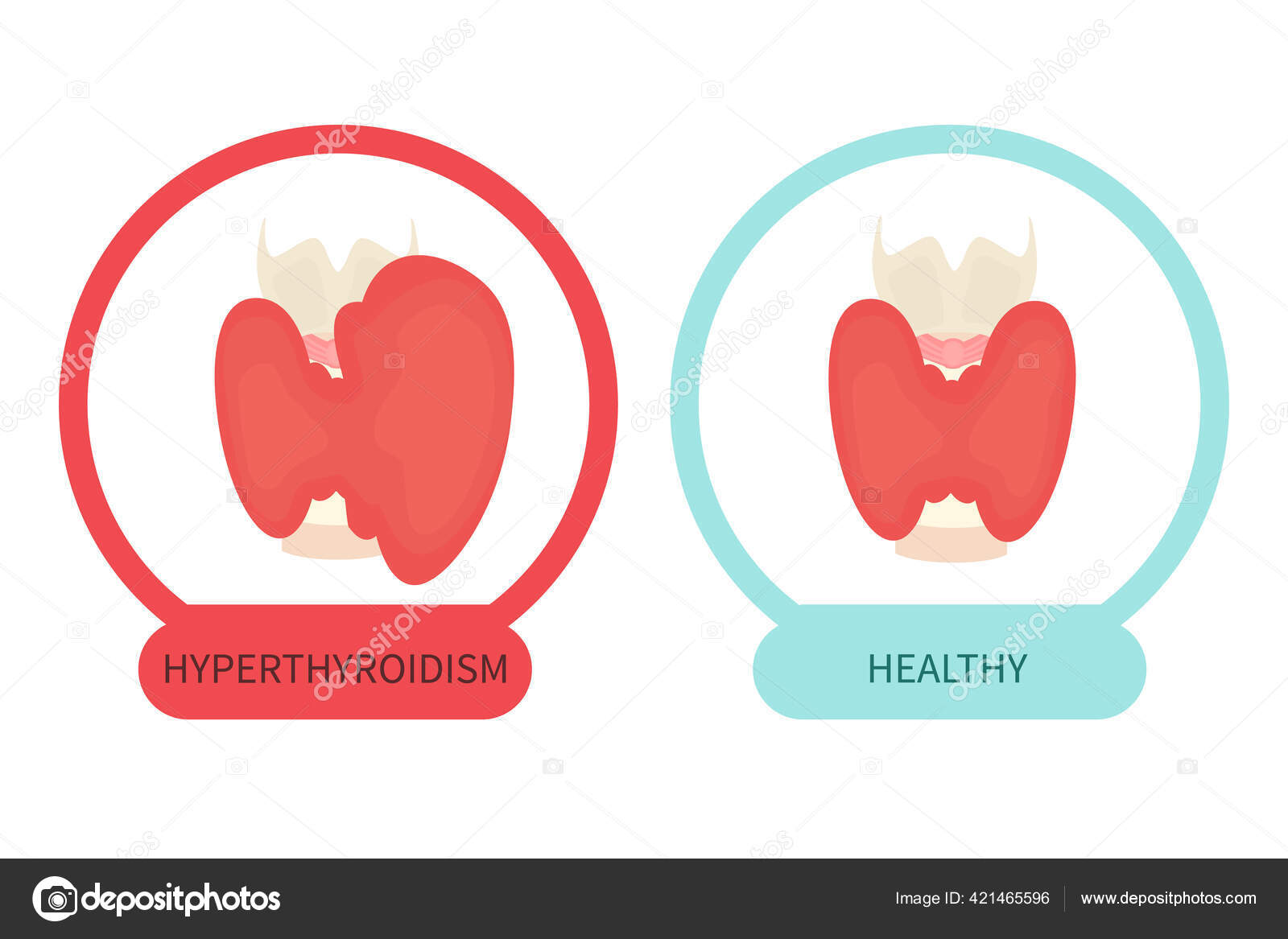 Inflamed Thyroid Animation
