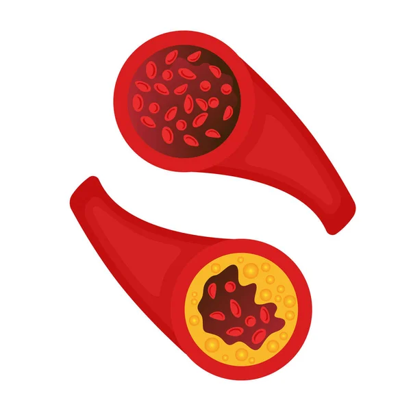 Ilustración de la sección transversal de la arteria normal y estrecha 2023