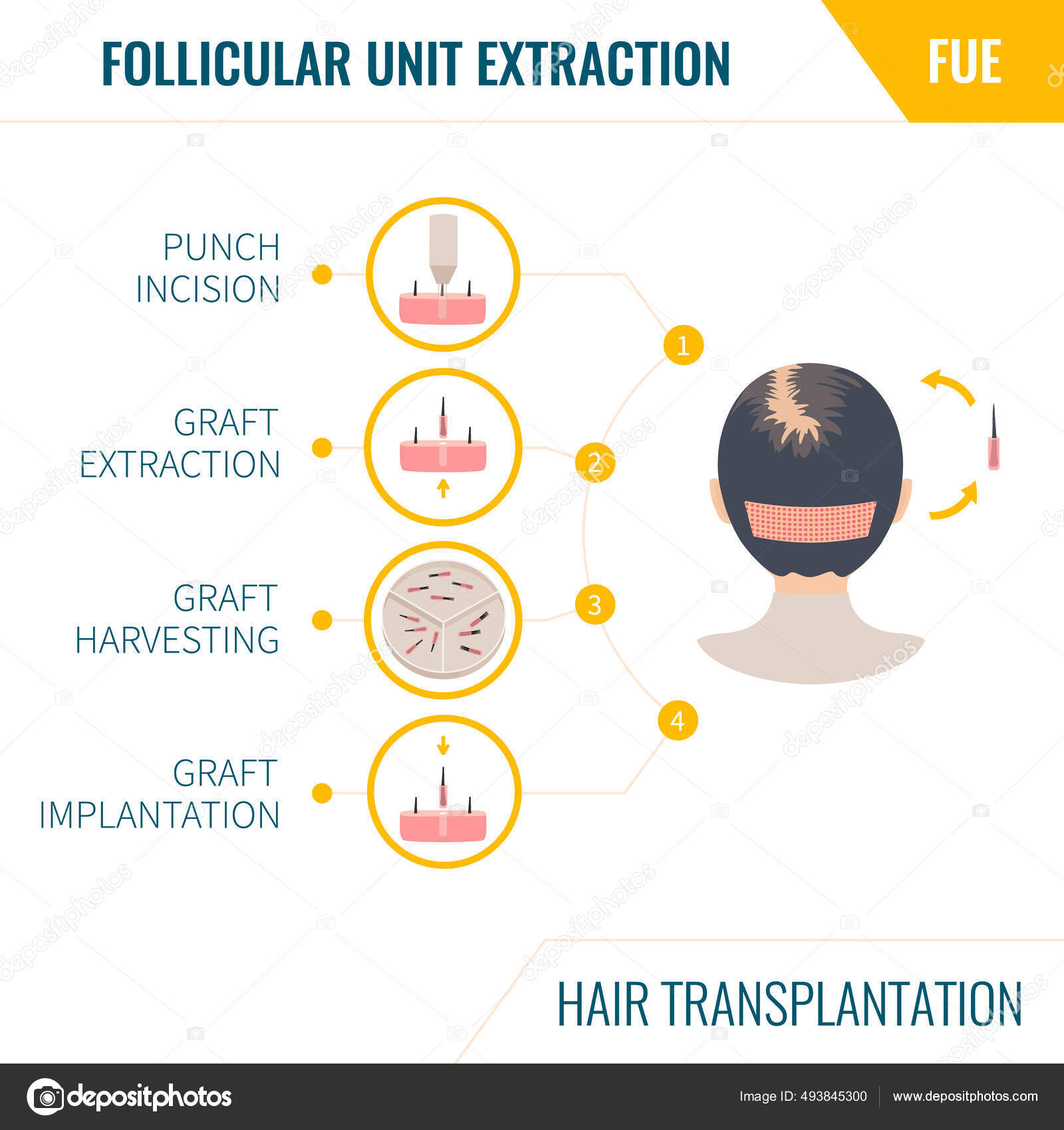 Hair transplantation by FUE method in women Stock Vector Image by ...