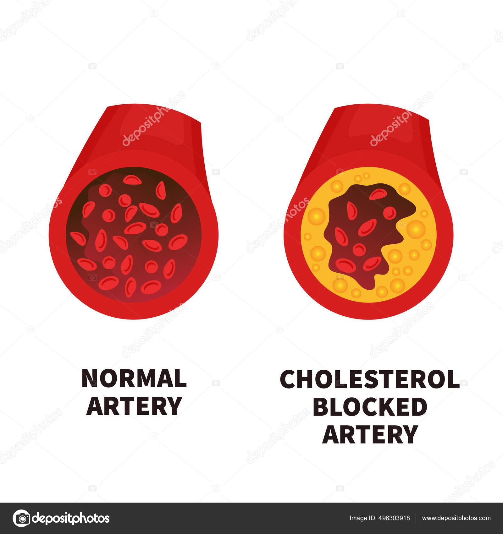 Normal and narrowed artery cross section illustration Stock Vector ...