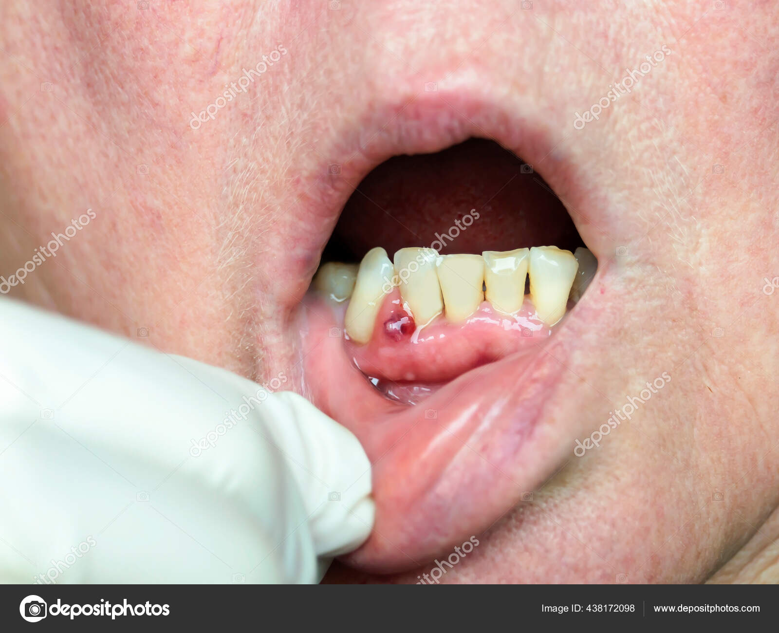 Blood Clot Inside Cheek