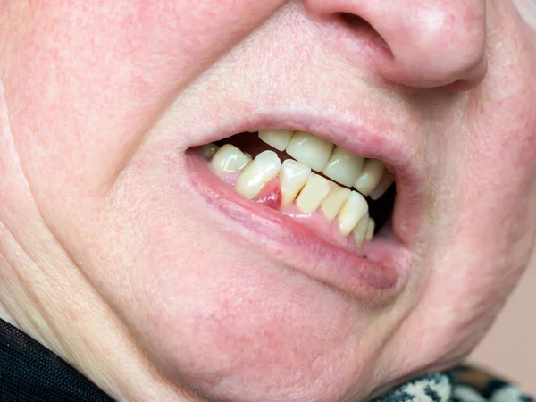 Purulent abscess Stock Photos, Royalty Free Purulent abscess Images ...