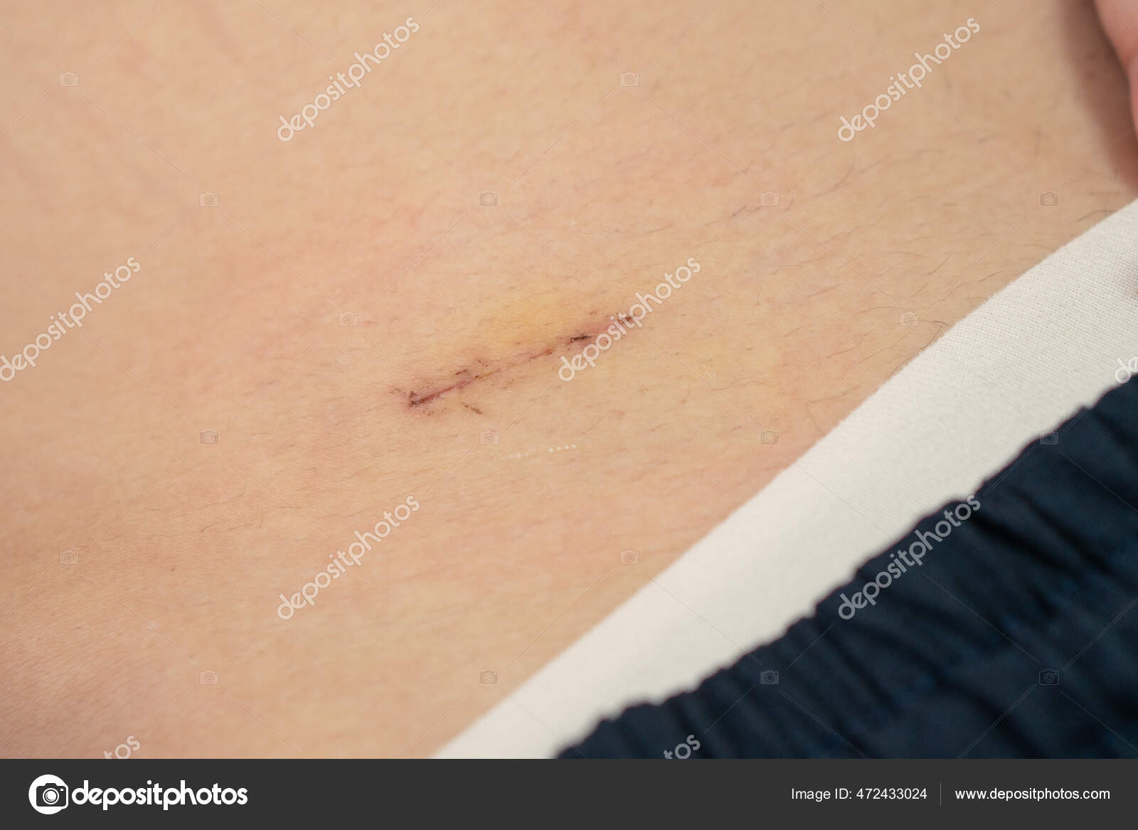 Fresh Appendix Surgical Wound Suture Removal Appendectomy Surgery ...