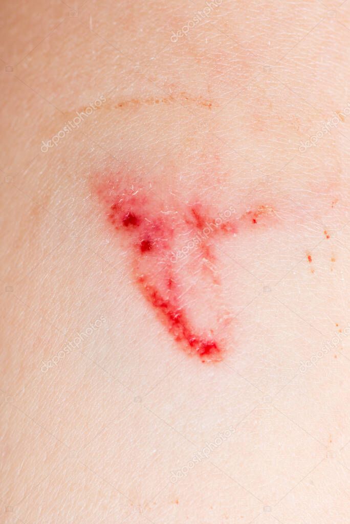 Una herida en el cuerpo humano, corte profundo, cicatriz en primer ...