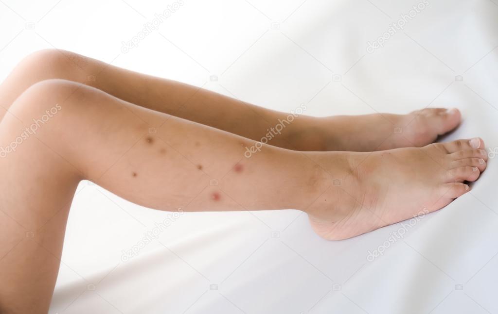 Mosquito bites sore on baby legs — Stock Photo © escapejaja #118648654 Mosquito bites sore on baby legs — Stock Photo © escapejaja #118648654