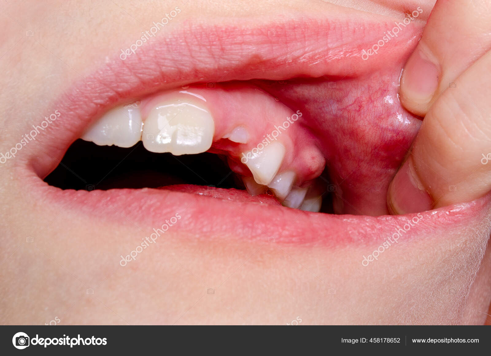 Gum Disease Tooth Decay Child Stock Photo by ©dimas8308 458178652