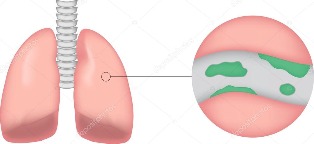 Bronchiectasis diagram on a white background Stock Vector Image by ...