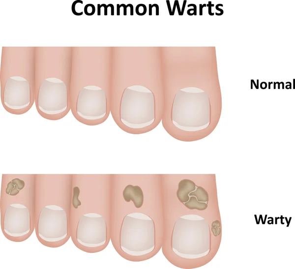 329 Warts Vector Images, Warts Illustrations | Depositphotos