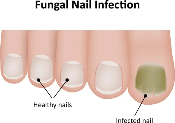 85 Toenail fungus Vector Images, Toenail fungus Illustrations ...