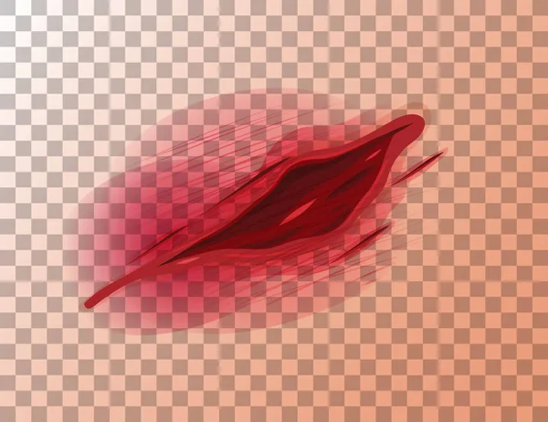 Wound Suturing Transparent Background Illustration Stock Vector Image ...